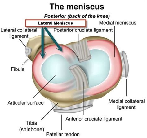Lateral Meniscus Tear Joi Jacksonville Orthopaedic Institute