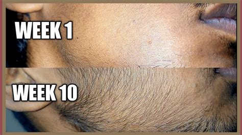How To Grow A Beard Minoxidil 5 Beard Growth Journey Week 1 To Week