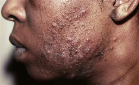Prurigo Nodularis More Likely In African Americans Dermatology Advisor