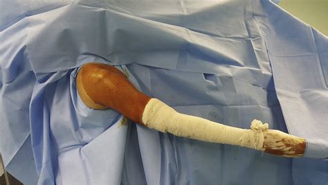 Biceps Tenodesis Recovery Time Renew Physical Therapy