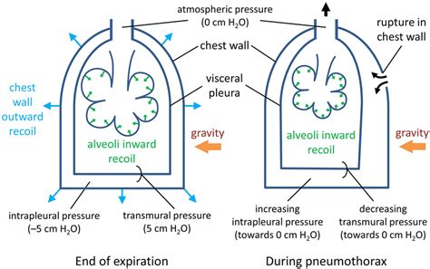 Pneumothorax Vs Tension Pneumothorax