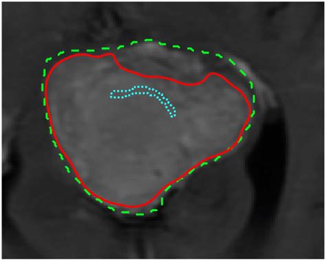 Brain Tumor With A Original Imagebuser Initialization C And