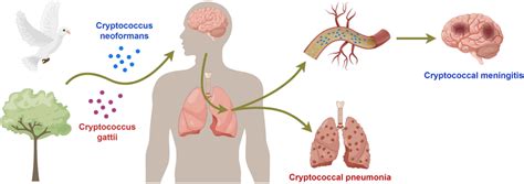 Routes Of Human Infection By C Neoformans And C Gattii By Figdraw