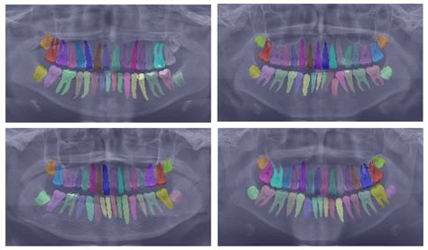Mask Transformer Based Networks For Teeth Segmentation In Panoramic