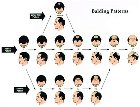 Hamilton Norwood Classification Of Mphl Download Scientific Diagram