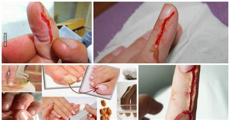 Hangnails Are Easy To Get Rid Of Thatviralfeed