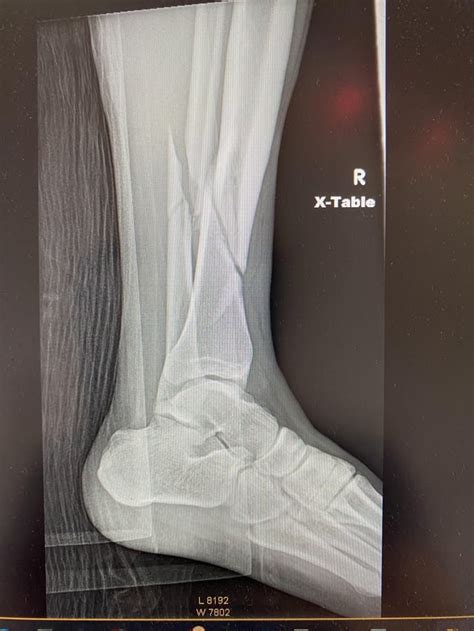 Anyone Had A Tib Fib Fracture And Got A Tibial Rod And Returned To Ultra Distance R Trailrunning