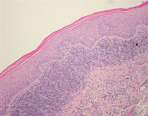 Low Power Hande Photomicrograph Shows A Mildly Atrophic Epithelium With A Download Scientific