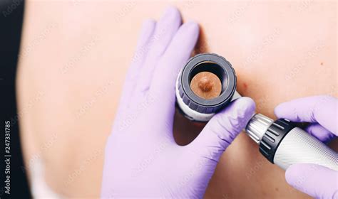 Dermatologist Examining A Large Mole On A Patient Back Using