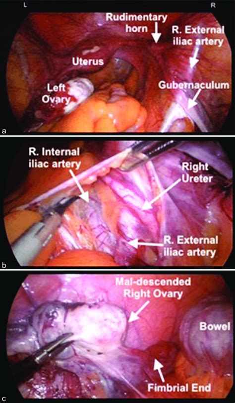 Female Pelvic Anatomy Laparoscopic