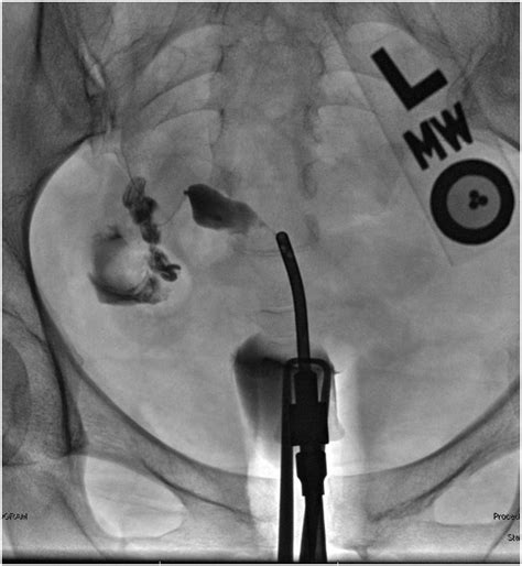 Hysterosalpingogram Showing Filling Of Right Uterus And Spillage From