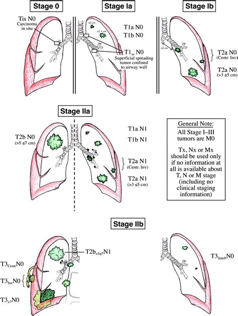 The Stage Classification Of Lung Cancer Chest