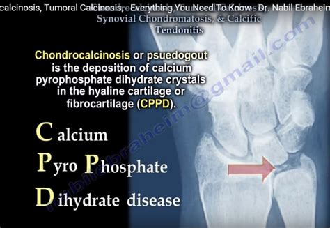 Chondrocalcinosis Nhs