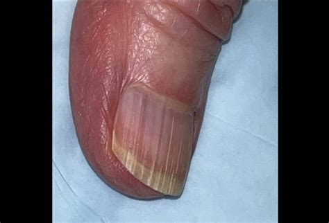 15 Fingernail And Toenail Abnormalities Indicators Of Patient Health