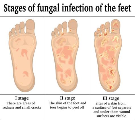1100 Fungal Skin Stock Illustrations Royalty Free Vector Graphics
