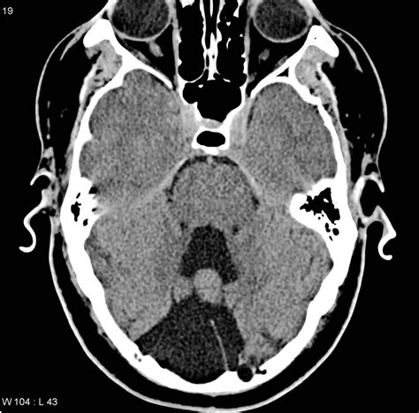 Dandy Walker Spectrum With Ossicular Malformation Radiology Case Radiology