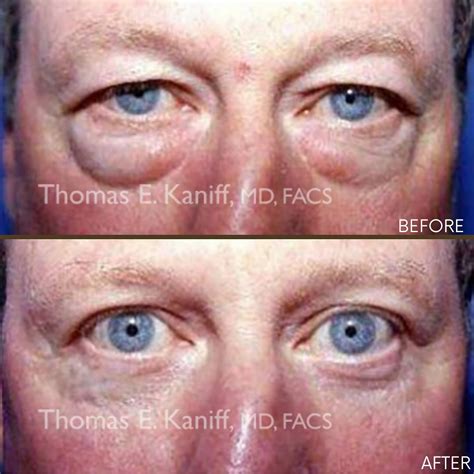 Dr Kaniff L Rhinoplasty Facelift Expert Drkaniff • Instagram