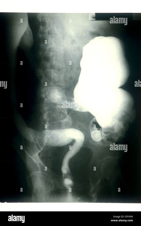 Ulcerative Colitis X Ray Ulcerative Colitis X Ray Stock Image