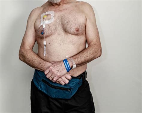 Chemo Port Procedure