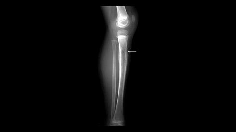 Ewing Sarcoma X Ray
