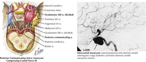 Third Cranial Nerve Anatomy