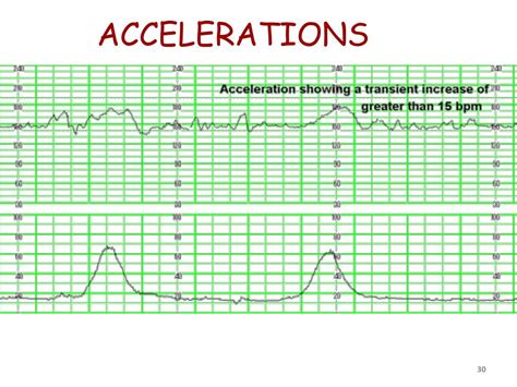 Ppt Electronic Fetal Monitoring Efm Cardiotocographyctg