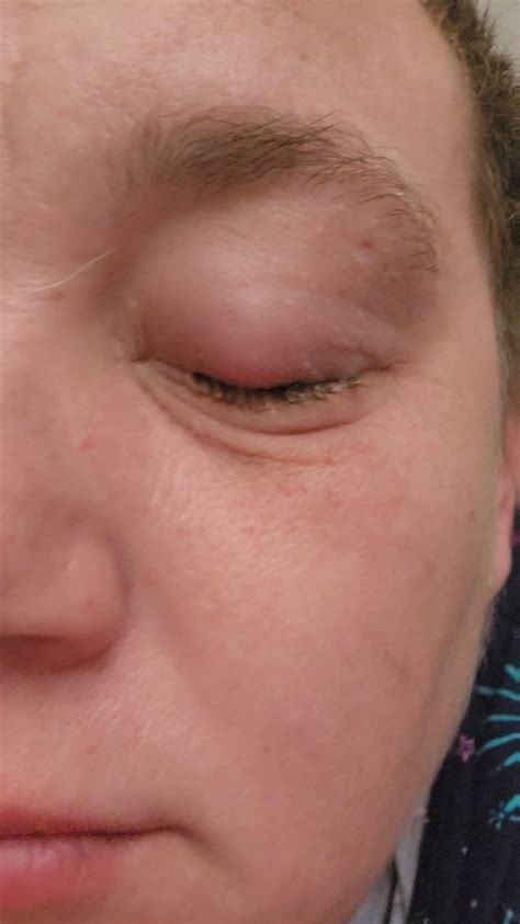 My Stye Drained While I Was Sleeping Rpopping