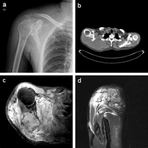A X Ray Images Show Right Scapula And That Distal Clavicle Is