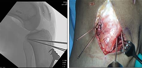 Figure 1 From The Influence Of Tibial Tuberclesparing Slope Reducing