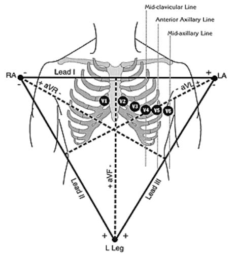 Ekg Flashcards Quizlet