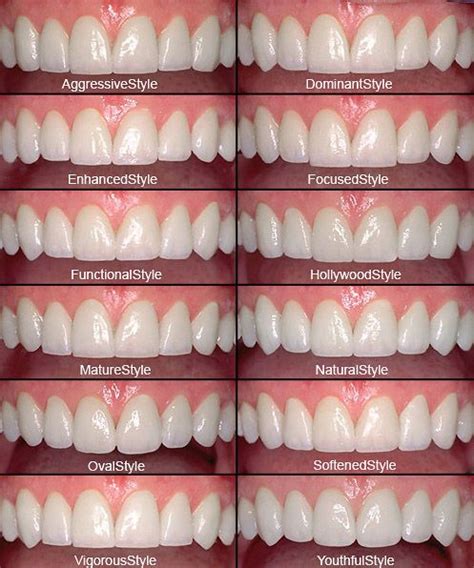 Denture Teeth Color Chart Moniquetemarks