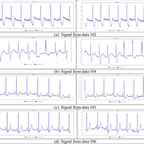 Block Diagram Of The Segmentation And Classification Of Ecg Signals