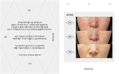 프락셀 제나 피코프락셀 프락셀 듀얼··· 프락셀 종류 왜이렇게 많아 프락셀 시술 차이점 총정리 롬바이