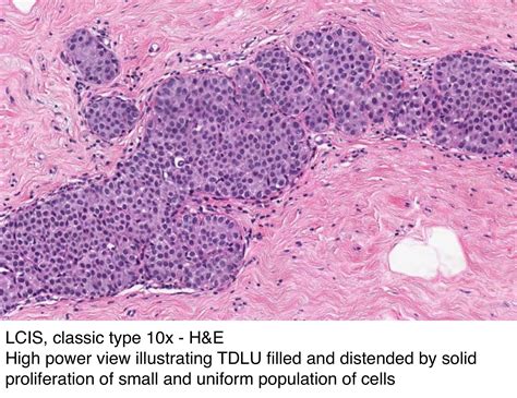 Pathology Outlines Lcis Classic