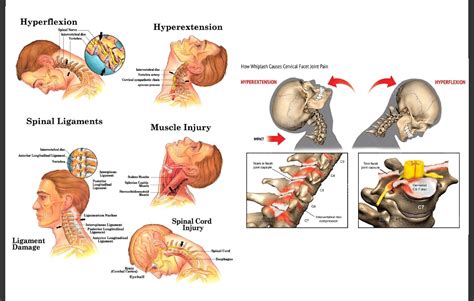 Neck Pain Causes And Types