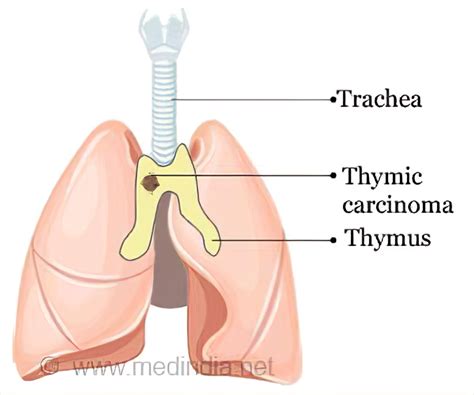 Thymic Tumor