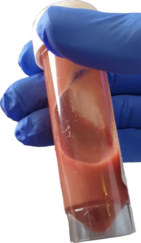 A Sample Of The Aspirated Abscess Fluid Reminiscent Of The Classic