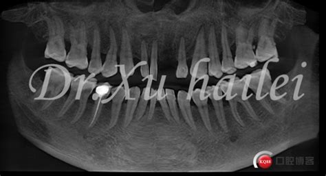 块状骨移植 许海磊的博客 Kq88口腔博客