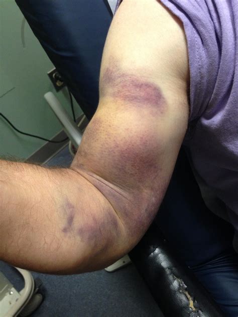 Biceps Tendon Rupture Jetem