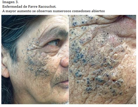 La Elastosis Nodular Todopiel Profdra Griselda De Anda