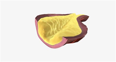 Premium Photo Bronchiectasis Results From Bacterial Infection Or As A Byproduct Of Another
