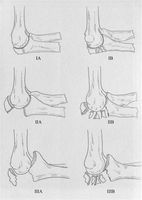 Proximal Ulna Fractures In Adults A Review Of Diagnosis And Management