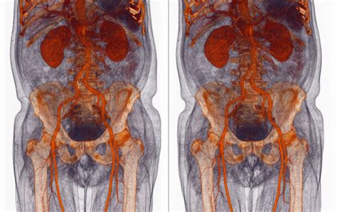 Runoff Angiography 1j By Voxel123 On Deviantart