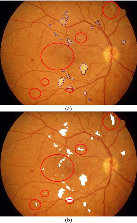 Figure 1 From Exudates Detection In Fundus Image Using Non Uniform