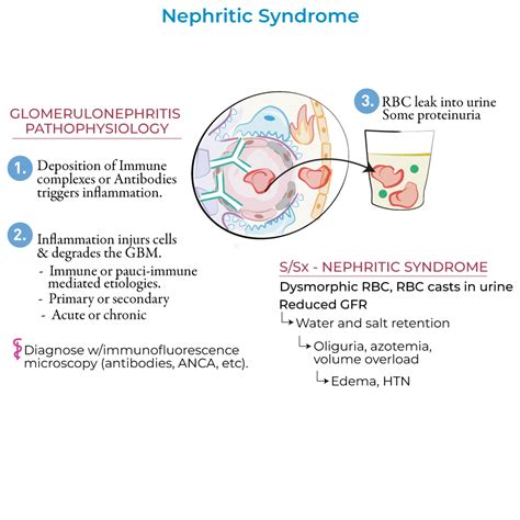 Clinical Pathology Glossary Nephritic Syndrome And Glomerulonephritis