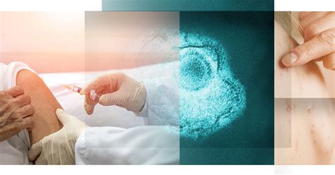 Beyond Preventing Shingles Udaily