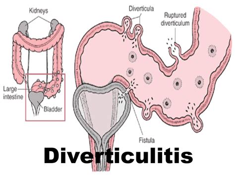 Diverticulitis And Its Nursing Managementppt