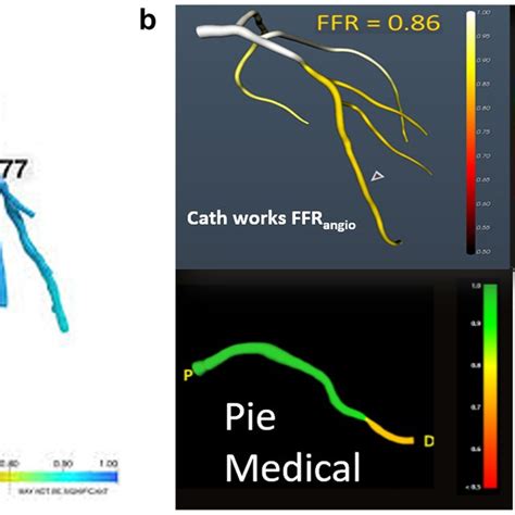 Eccentric Lesions Can Create The Appearance Of 2060 Stenosis On