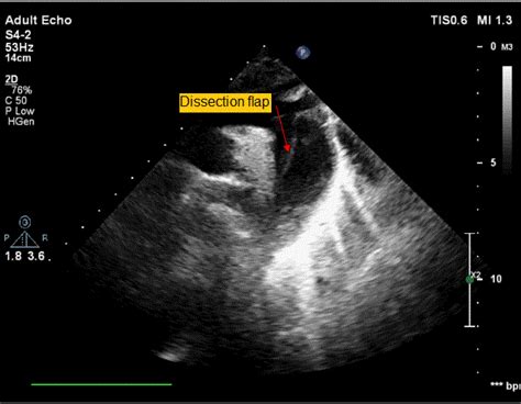 Suprasternal View Revealing A Dissection Flap Just Below The Left