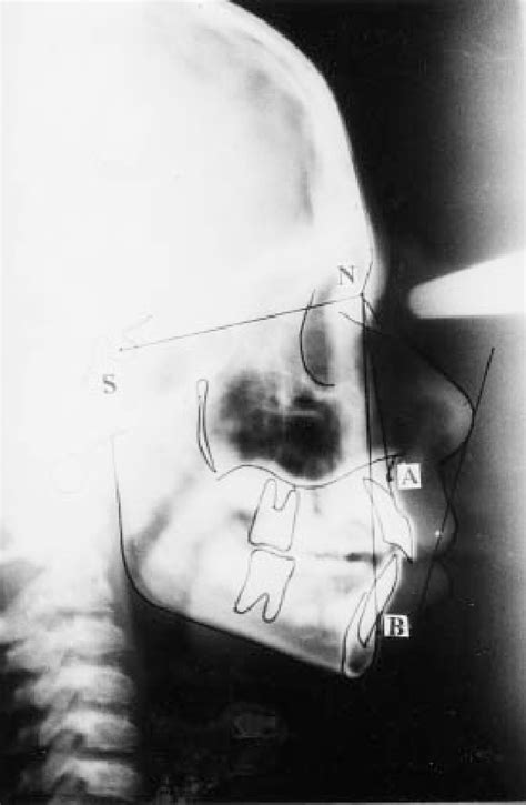 Cephalogram Of A Williams Syndrome Patient With Normal Sna And Snb
